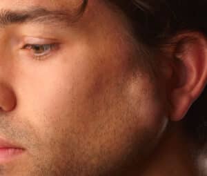 Lipome : causes et traitements | Clinique Skin Marceau | Paris