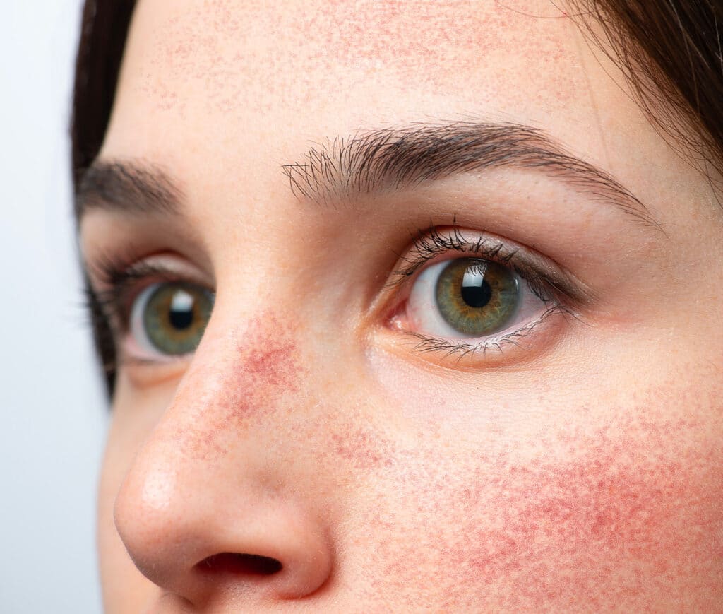 Laser treatment for rosacea in Paris | Skin Marceau Clinic