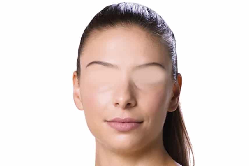 Acide hyaluronique pommettes à Paris | Médecine esthétique | Skin Marceau Acide hyaluronique pommettes à Paris | Médecine esthétique | Skin Marceau