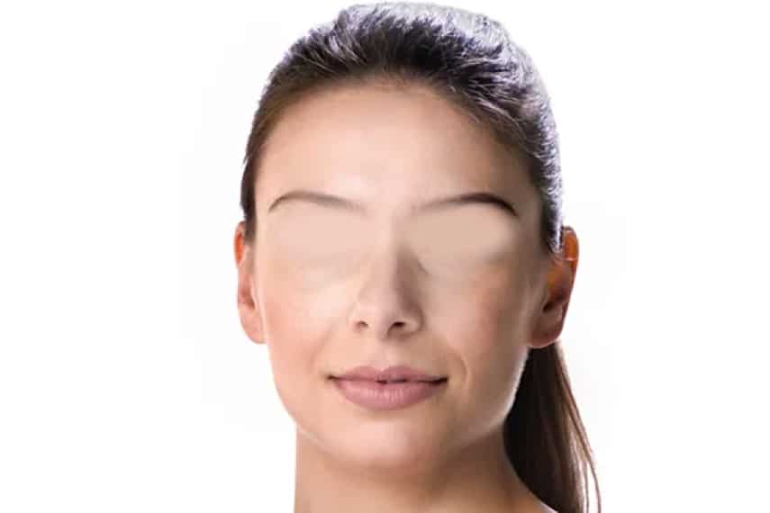 Acide hyaluronique pommettes à Paris | Médecine esthétique | Skin Marceau