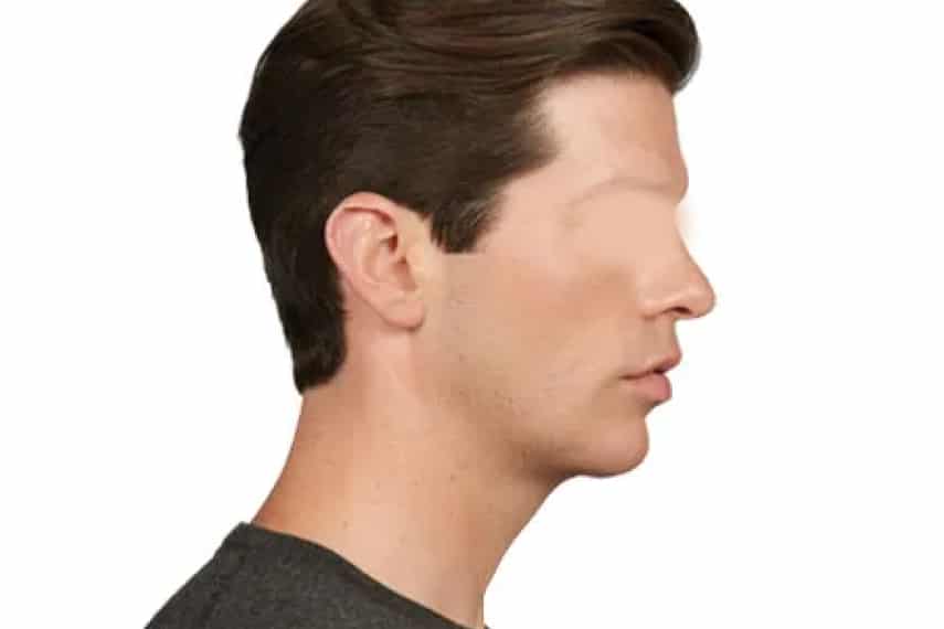 Acide hyaluronique menton à Paris | Médecine esthétique | Skin Marceau