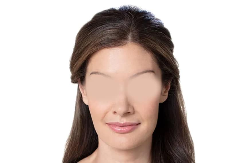 Botox front à Paris | Dermatologue esthétique | Clinique Skin Marceau