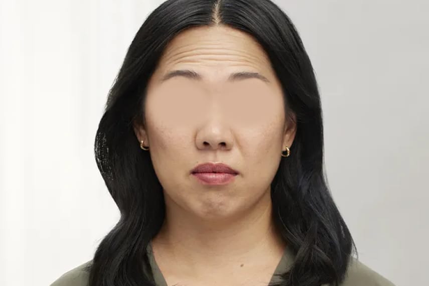 Botox front à Paris | Dermatologue esthétique | Clinique Skin Marceau