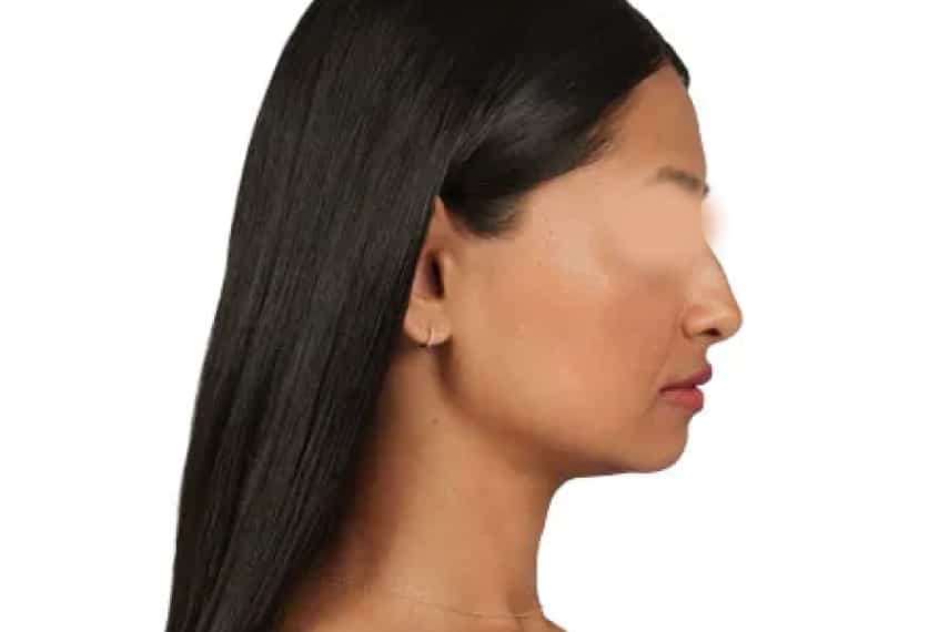 Acide hyaluronique menton à Paris | Médecine esthétique | Skin Marceau