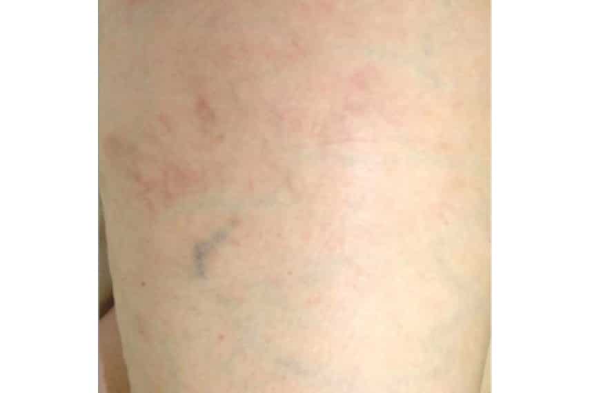 Avant / après de Dermatologie | Clinique Skin Marceau | Paris