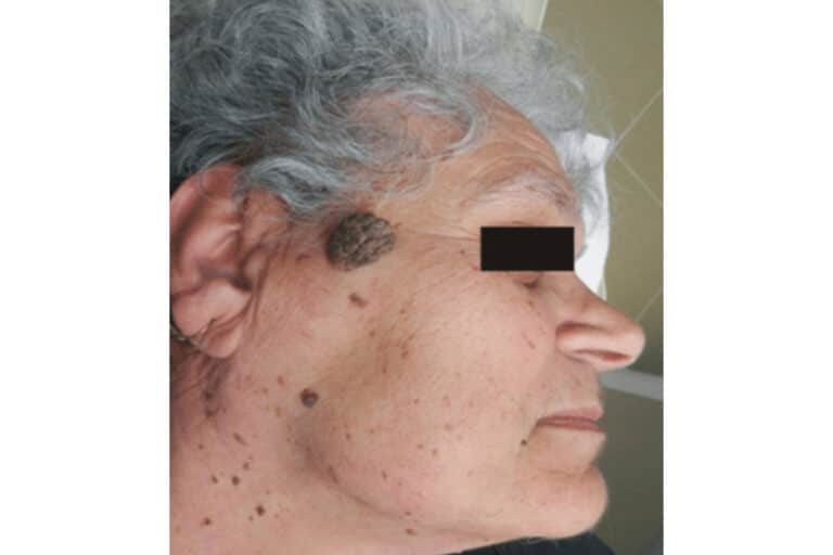 Seborrheic Keratosis: Causes and Treatments | Skin Marceau | Paris