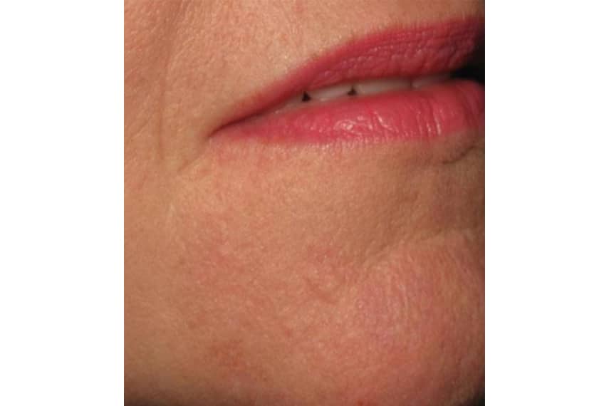 Enlever les grains de beauté au laser à Paris | Dermatologue esthétique ...