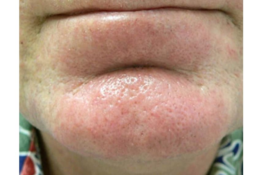 Avant / après de Dermatologie | Clinique Skin Marceau | Paris