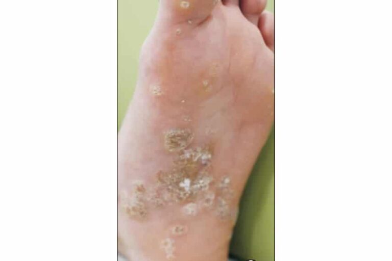 Traitement des verrues à Paris | Clinique laser dermatologique | Skin ...