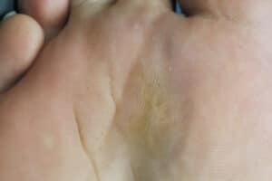 Verrue : causes et traitements | Dermatologie médicale | Skin Marceau ...